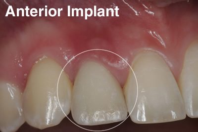 Dental Implants | Anterior Implant | Single Dental Implant