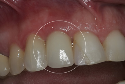 Dental Implants | Anterior Implant | Single Dental Implant