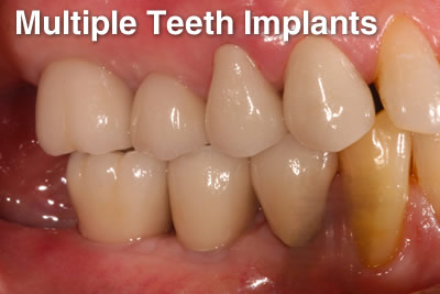 Implant Bridge | Replacing Multiple Teeth | Dental Implants