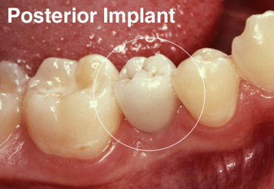 Tooth Replacement | Dental Implant | Posterior Implant