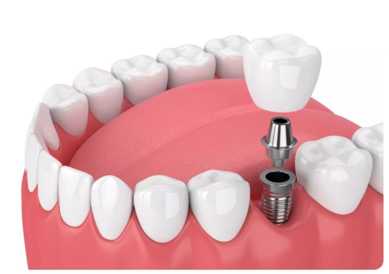 Tooth Replacement | Dental Implant | Posterior Implant