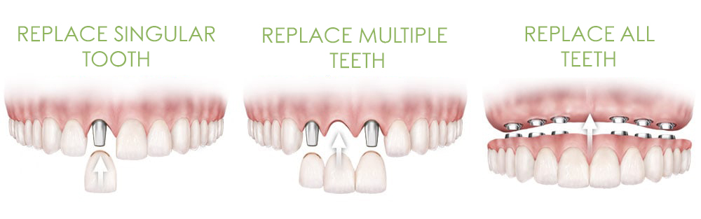 Implant Bridge | Replacing Multiple Teeth | Dental Implants Implant Bridge | Replacing Multiple Teeth | Dental Implants